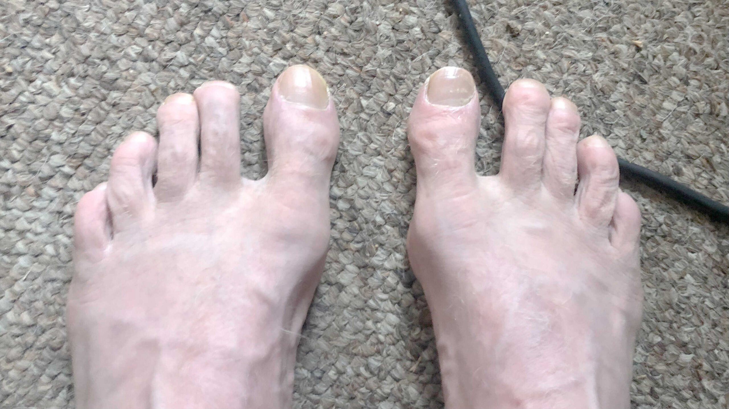 No Detectable Foot Pulse, But Pink Toes, With Peripheral Arterial ...