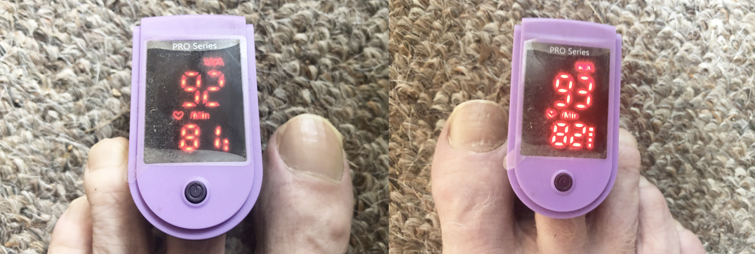 Peripheral Arterial Disease Collateral Arterial Growth Assessment Using ...