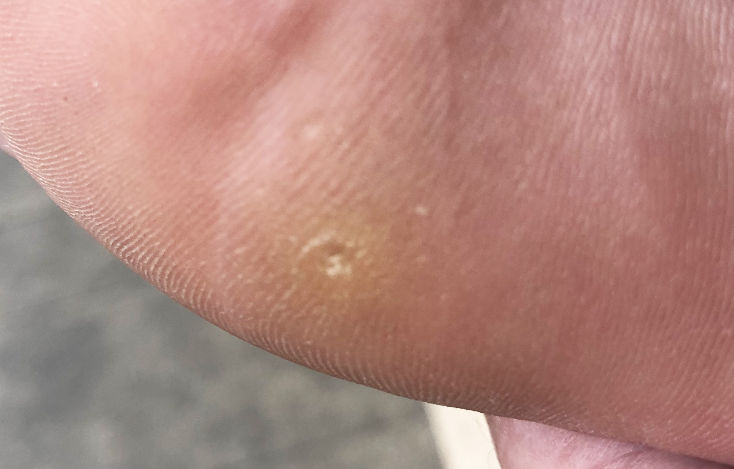 Notes on Peripheral Arterial Disease Running Progress: No Socks No ...